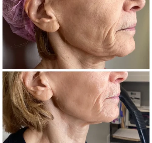 Tixel Before & After Portfolio | Marco Island Aesthetics — Marco Island ...