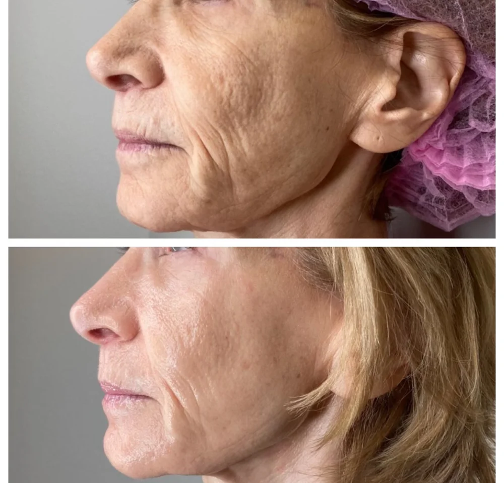 Tixel Before & After Portfolio | Marco Island Aesthetics — Marco Island ...