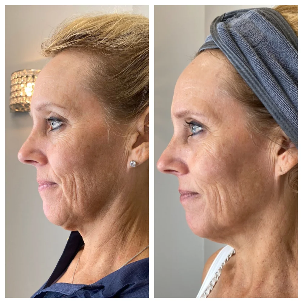 Tixel Before & After Portfolio | Marco Island Aesthetics — Marco Island ...