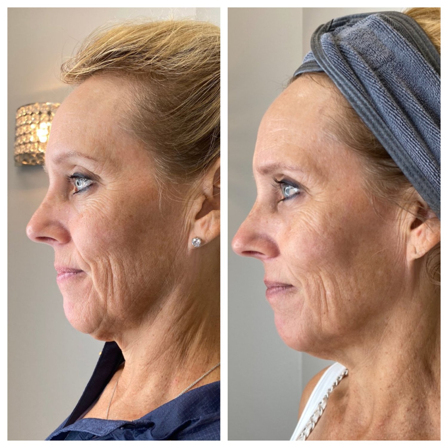 Tixel Before & After Portfolio | Marco Island Aesthetics — Marco Island ...