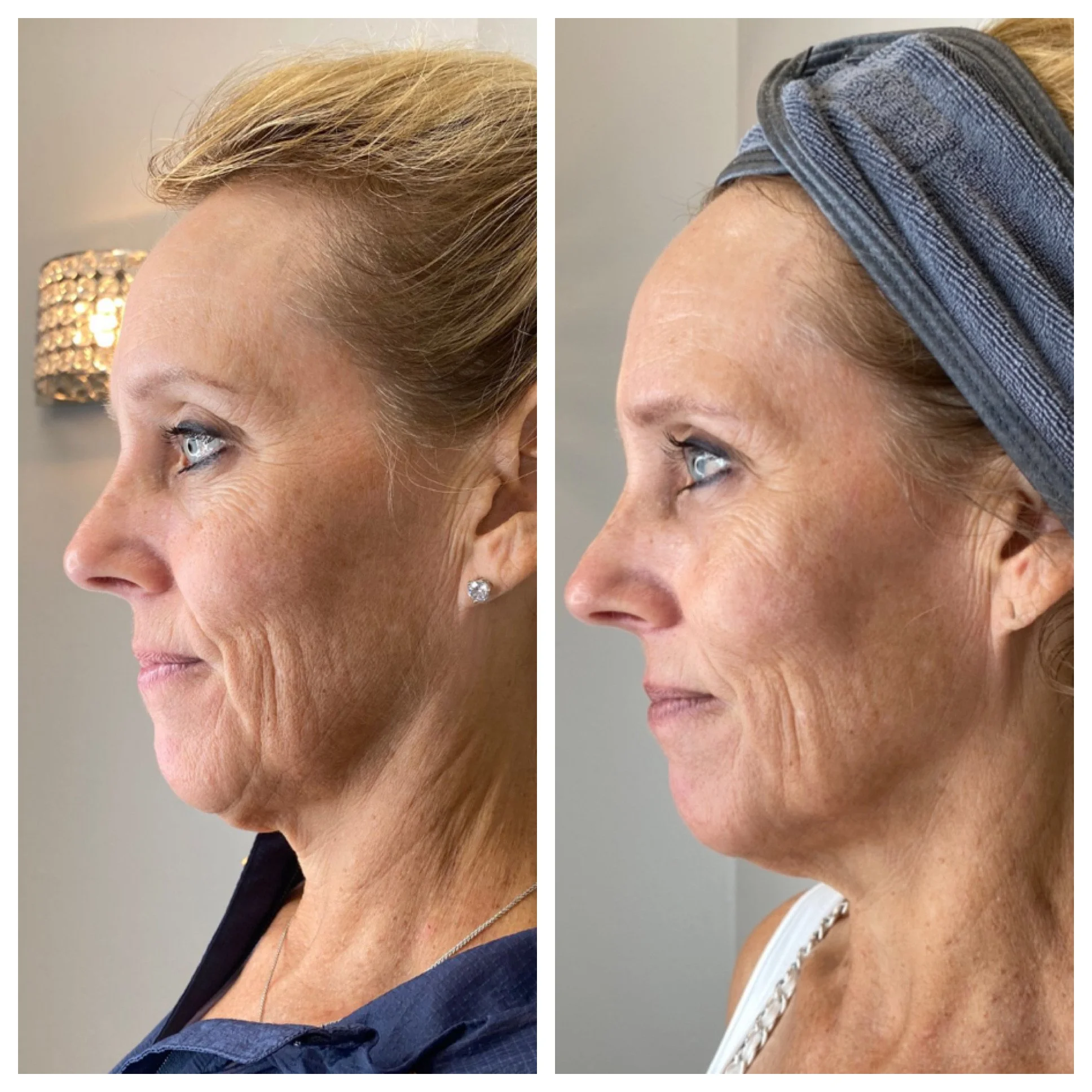 Tixel Before & After Portfolio | Marco Island Aesthetics — Marco Island ...