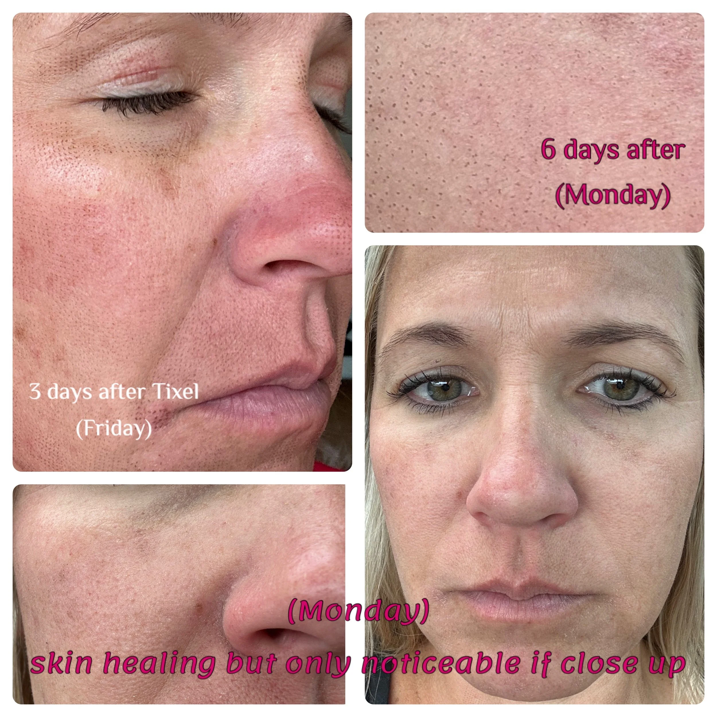 Tixel Before & After Portfolio | Marco Island Aesthetics — Marco Island ...