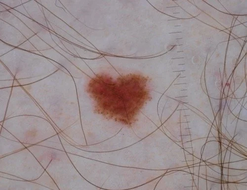 Naevi (Moles) — Dr Andrew Brunton