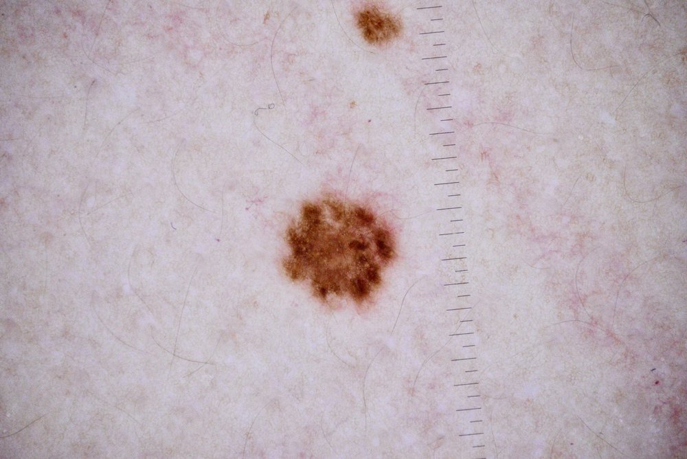 Naevi (Moles) — Dr Andrew Brunton