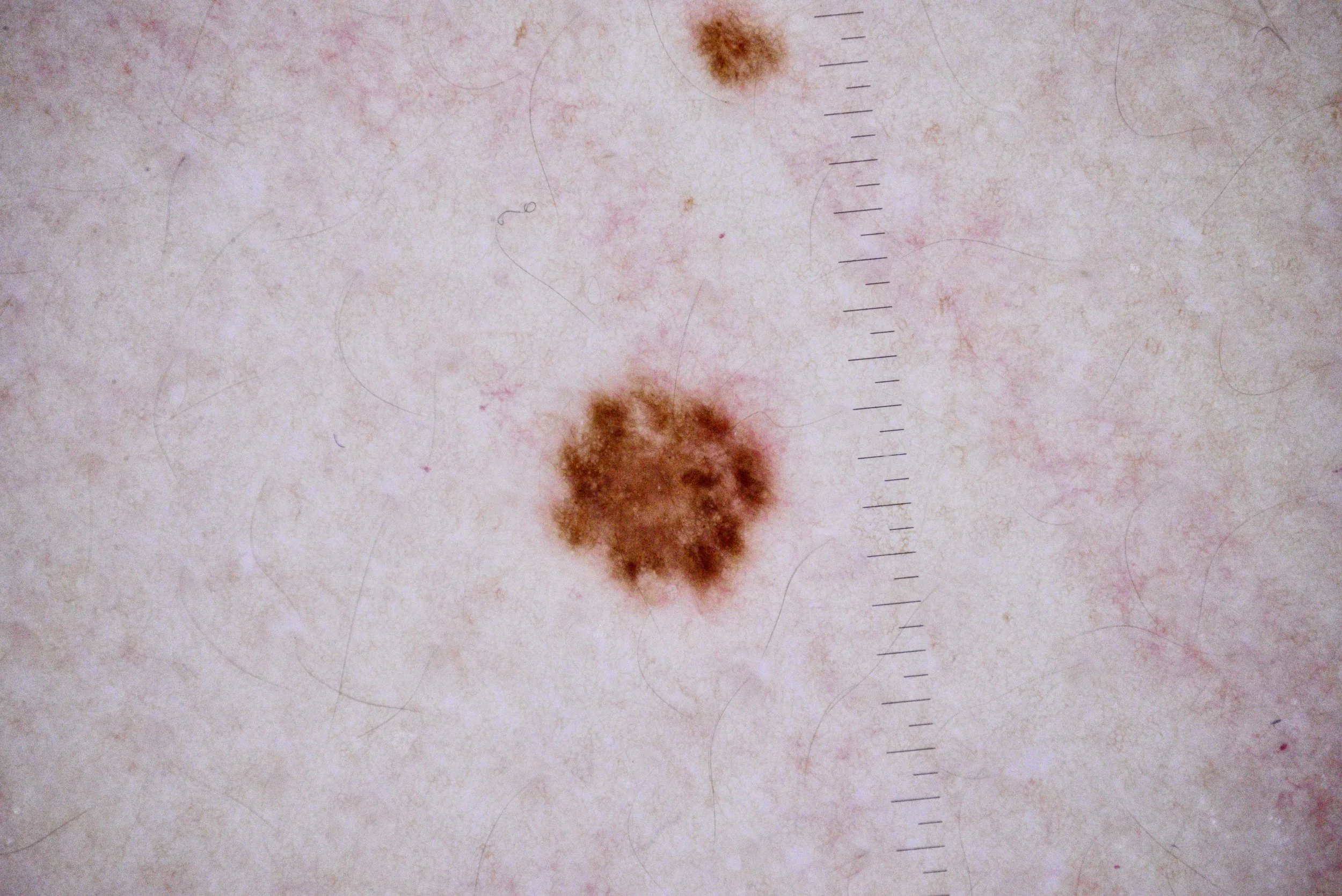 Naevi (Moles) — Dr Andrew Brunton