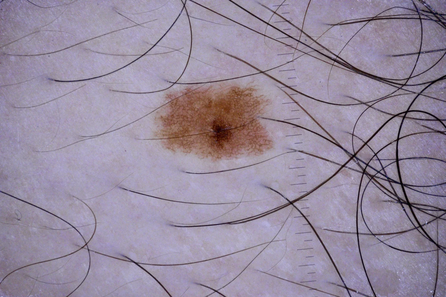Naevi (Moles) — Dr Andrew Brunton