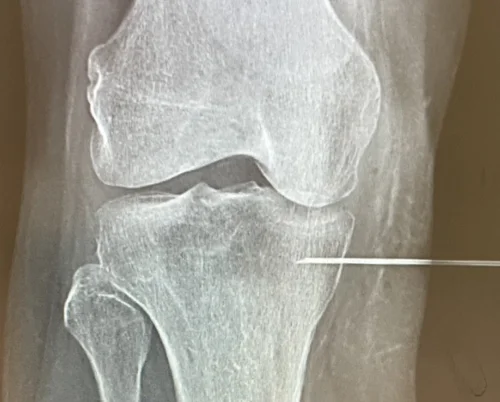 Advancing Regenerative Medicine: The Superior Potential of Subchondral ...