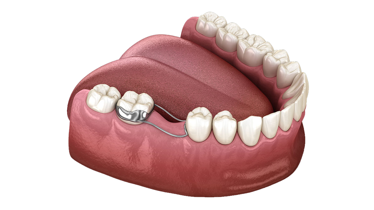 Space Maintainers — Athens Area Pediatric Dentistry