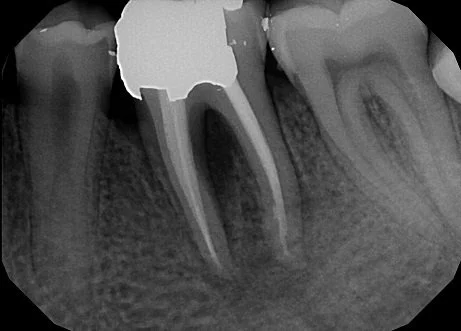 Root Canal Therapy — Morgan Heights Dental Centre