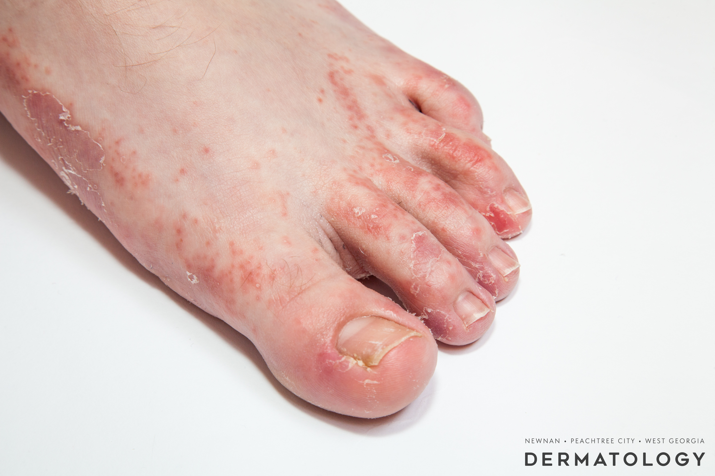 Athlete's Foot Treatment at Peachtree City Dermatology — Peachtree City ...