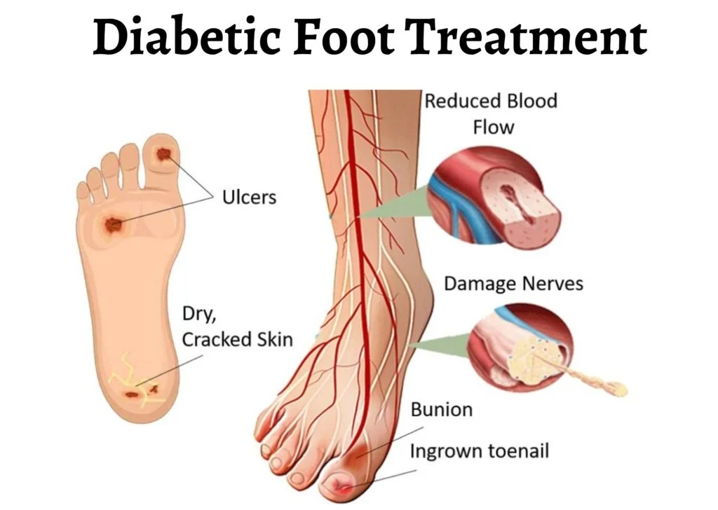 What Is Diabetic Foot & How to Treat It