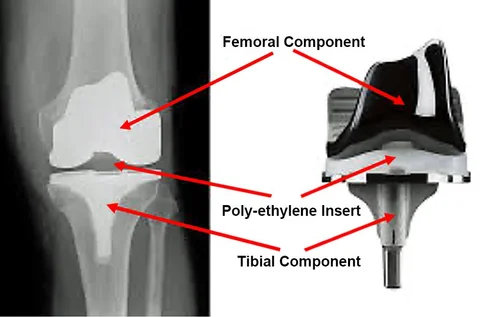 Totally Knee Arthroplasty — Michael L. Parks, MD
