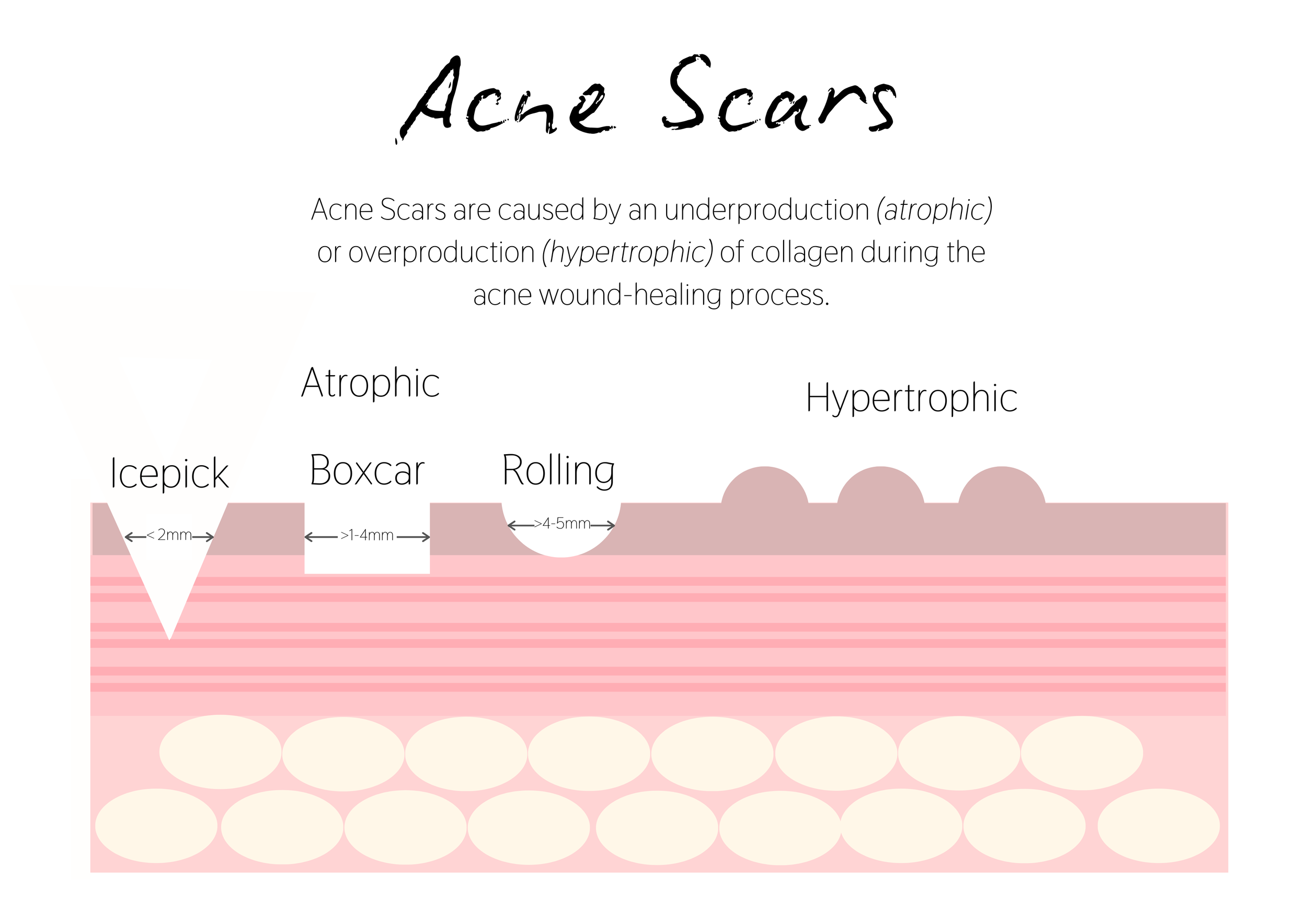 Post-Acne Scarring: What It Is and How We Can Treat | Birkdale Skin ...