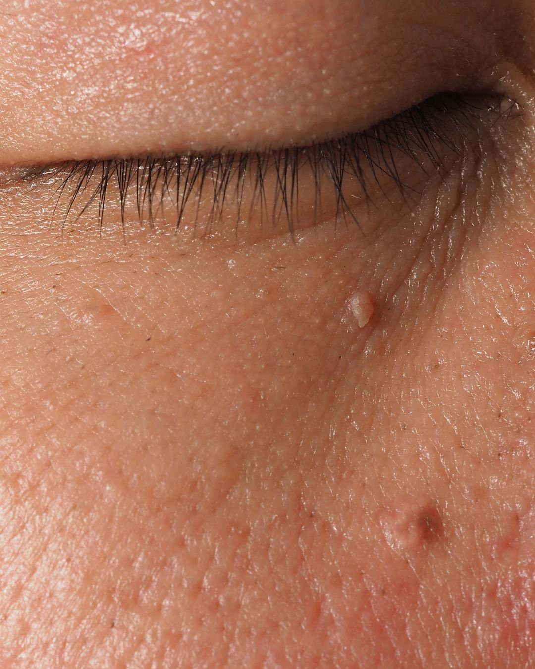 Skin Tag Removal Hale, Altrincham | Doctor-Led Electrocautery — Dr ...