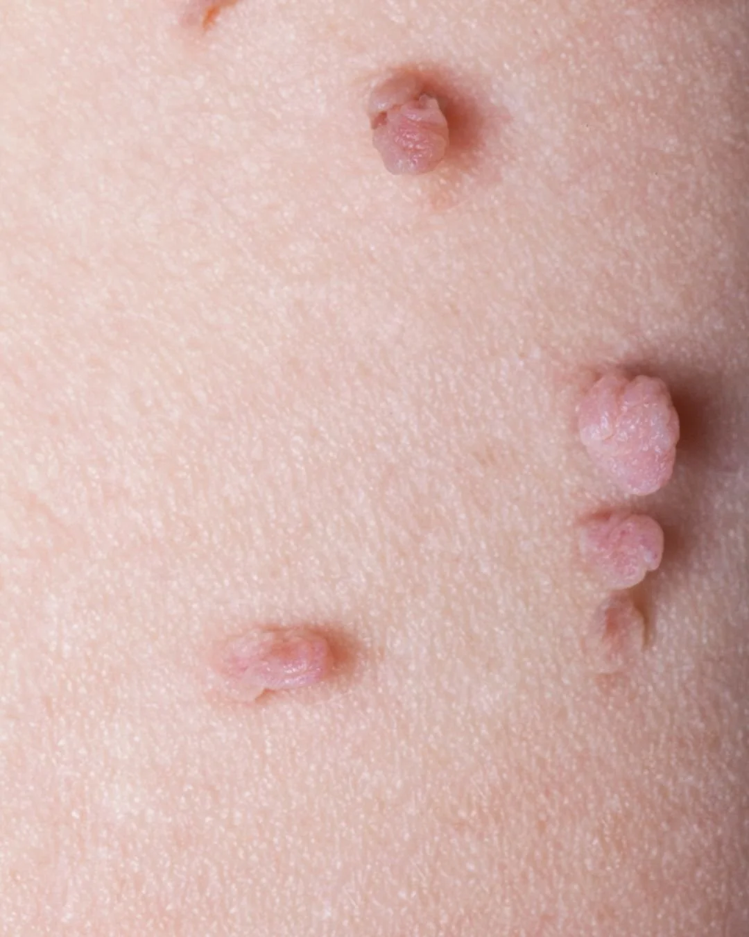 Skin Tag Removal Hale, Altrincham | Doctor-Led Electrocautery — Dr ...