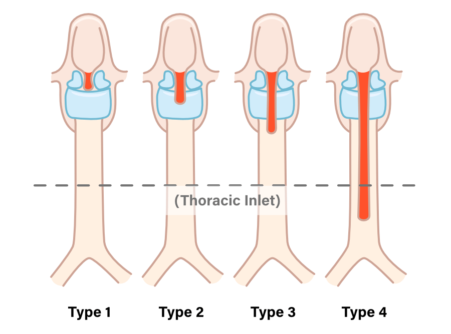 What Is a Laryngeal Cleft? — Laryngeal Cleft Network