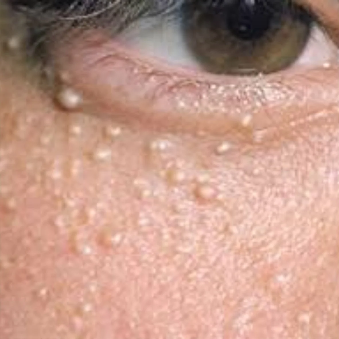 Milia Or Milk Spots Skin Hub Expert Skin Blemish Removal Milia Or Milk Spots Skin Hub Expert Skin Blemish Removal