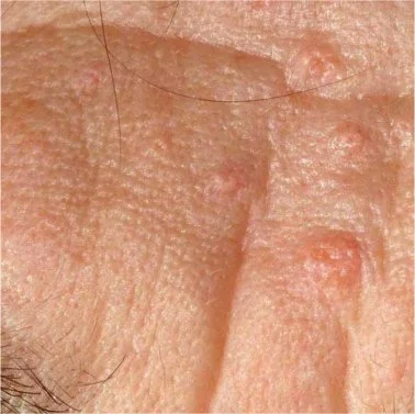 Sebaceous Hyperplasia — Skin Hub - Expert Skin Blemish Removal
