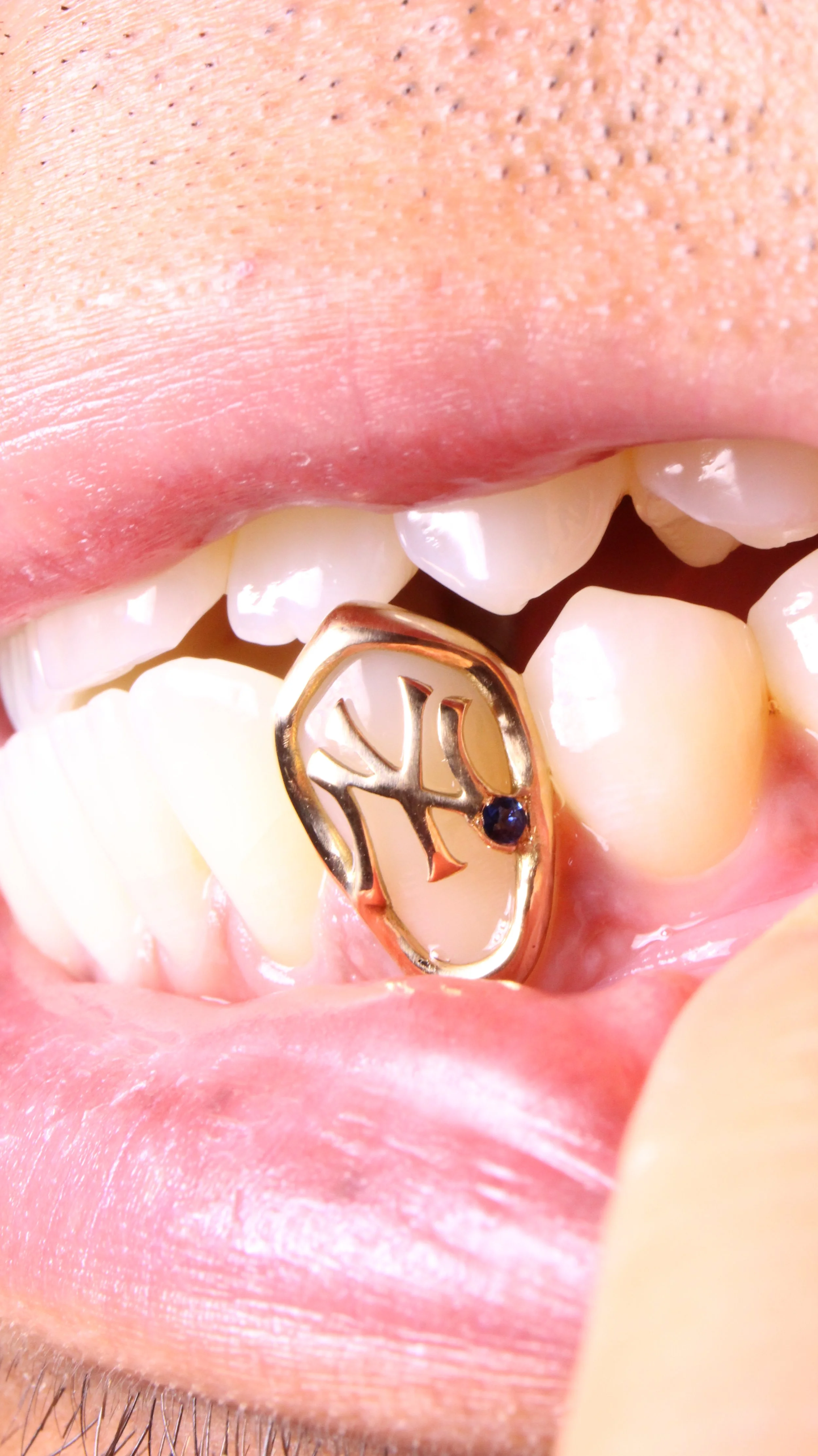 Grillz à Genève, Lausanne, Fribourg et Zürich — RH Dental