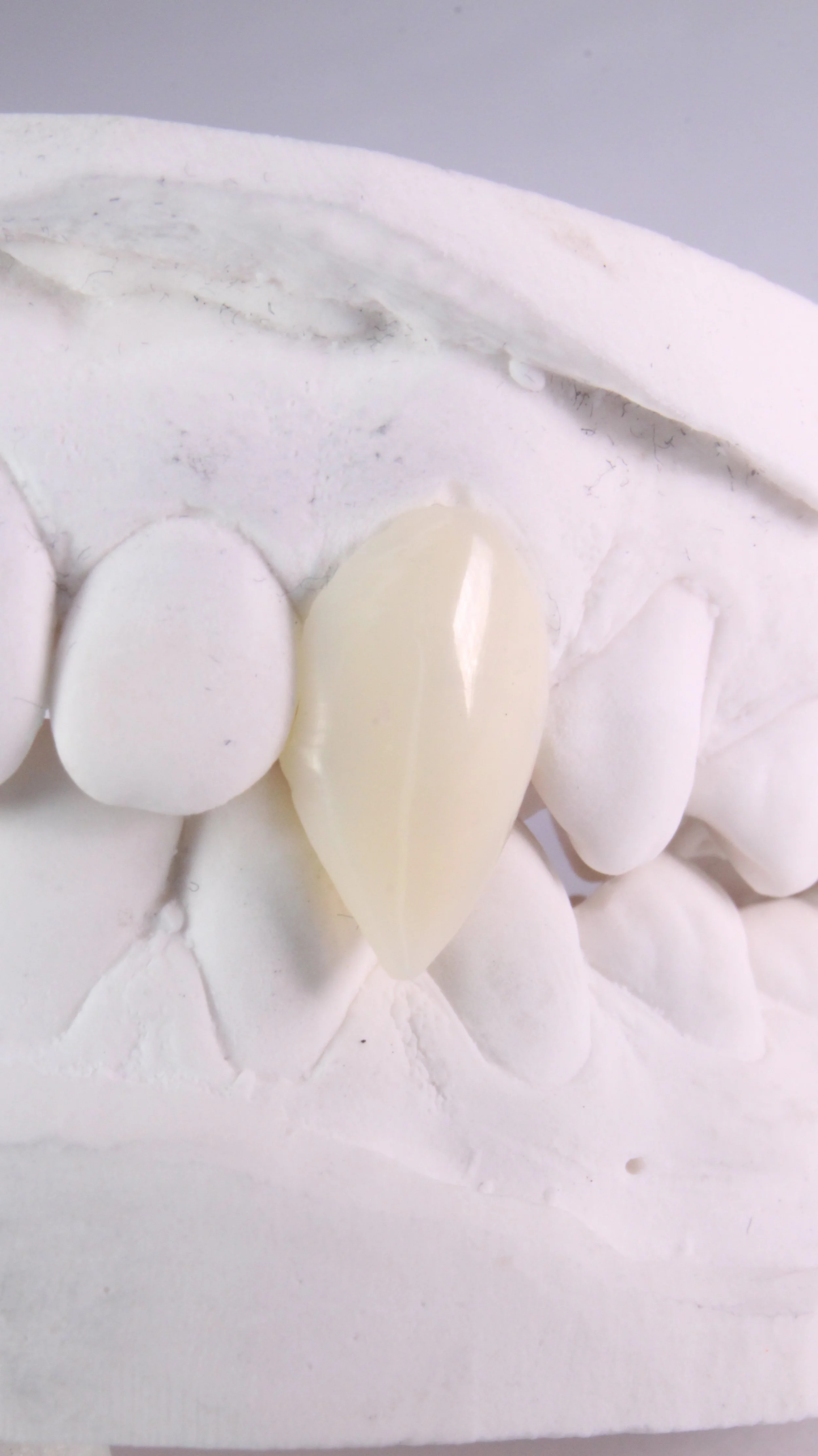 Grillz à Genève, Lausanne, Fribourg et Zürich — RH Dental