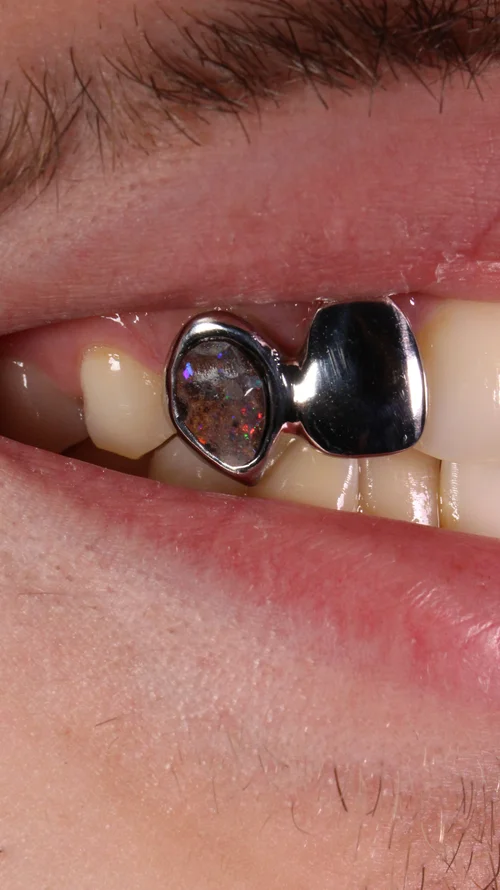 Grillz à Genève, Lausanne, Fribourg et Zürich — RH Dental