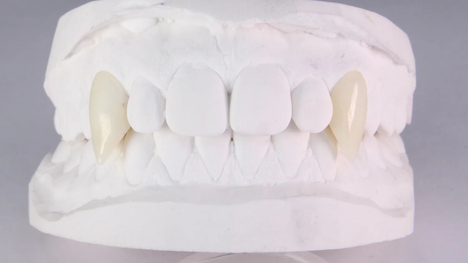Grillz à Genève, Lausanne, Fribourg et Zürich — RH Dental
