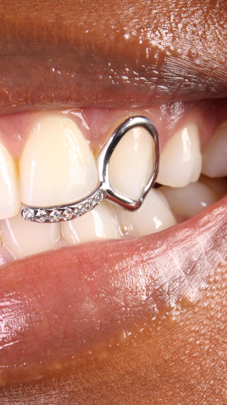 Grillz à Genève, Lausanne, Fribourg et Zürich — RH Dental