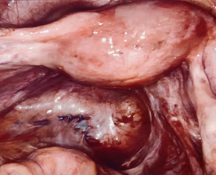 Adhesions — The Center for Endometriosis Care