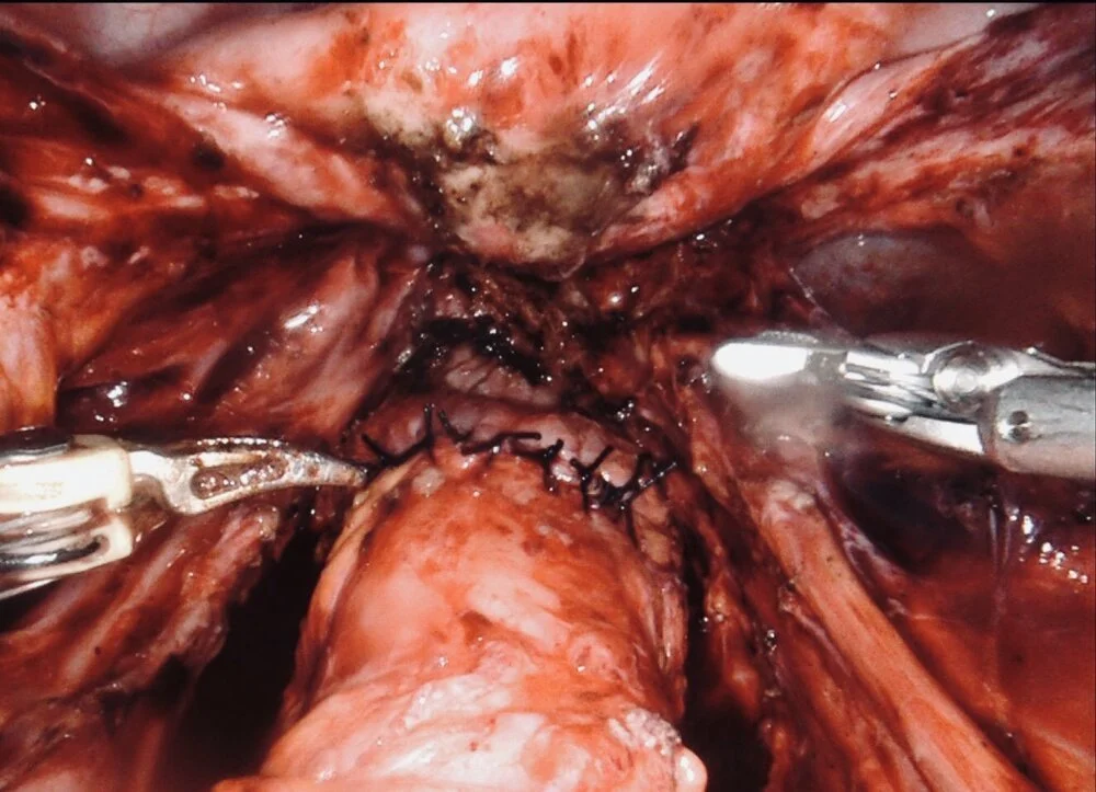 Adhesions — The Center for Endometriosis Care