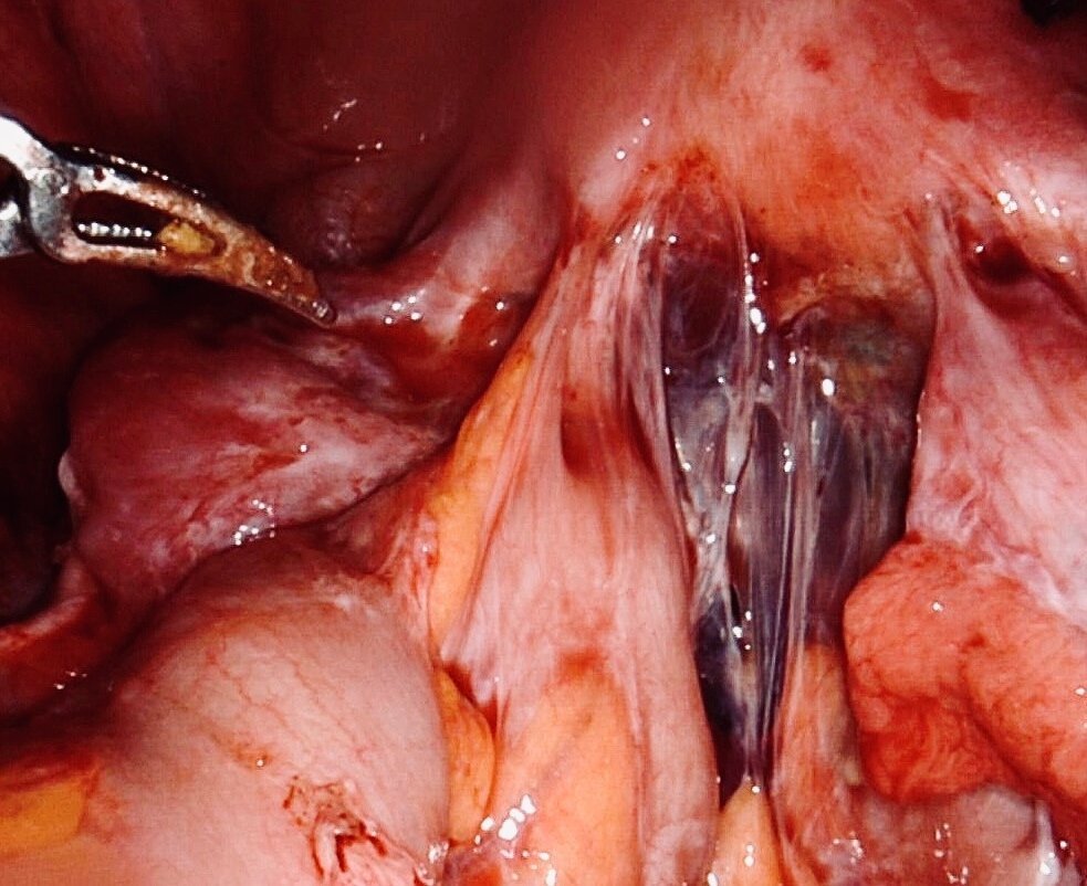 Adhesions — The Center for Endometriosis Care
