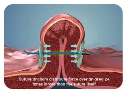Snowshoe Suture Anchors — USGI Medical Website