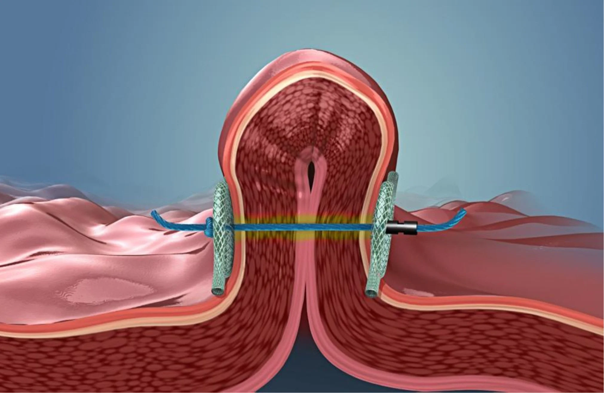 USGI Medical Website