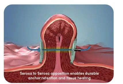 Snowshoe Suture Anchors — USGI Medical Website