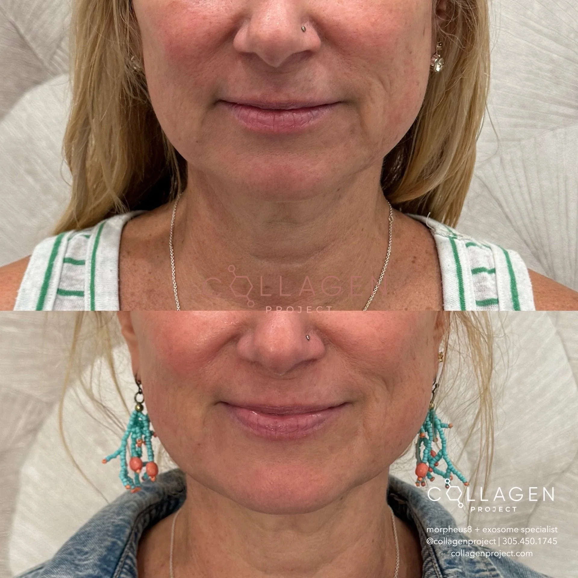 The Future of Skin Regeneration This Spring — Collagen Project (NEW)