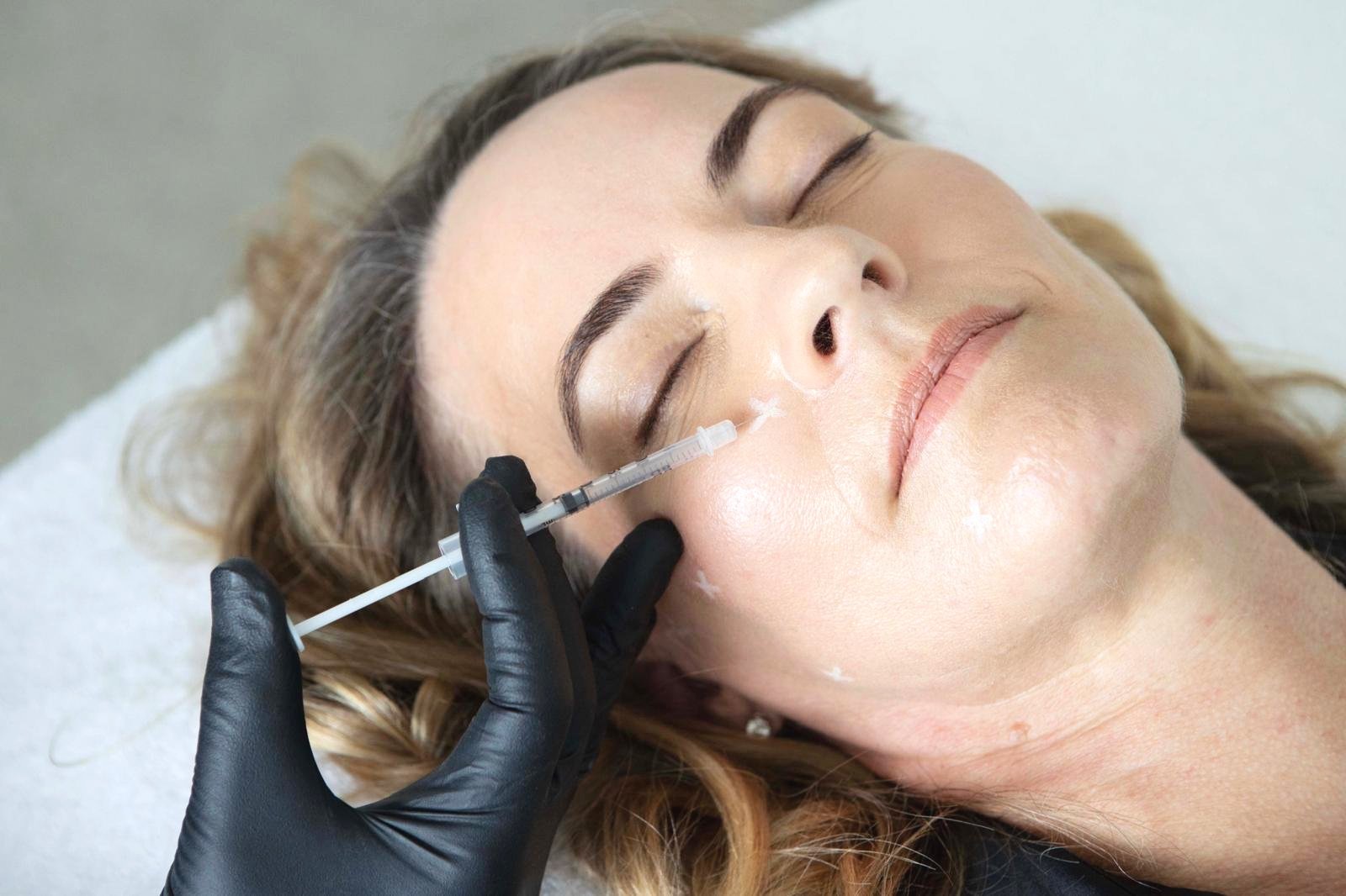 Profhilo Bioremodelling Skin Treatment | Achieve Radiant Skin Today ...