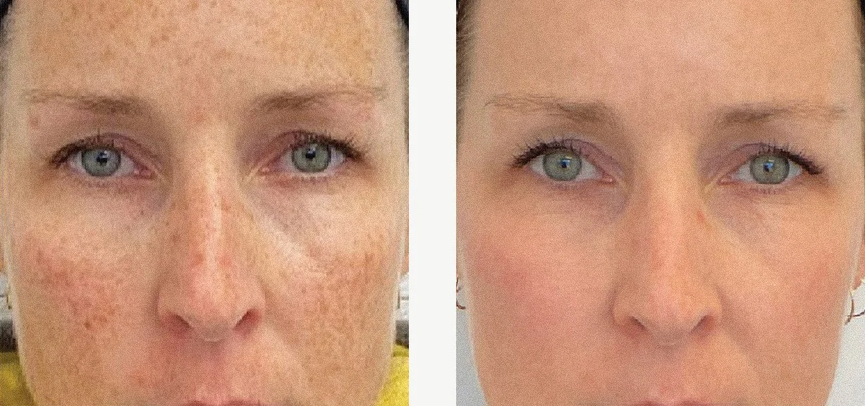 BBL Corrective | Transform Your Skin — The Skin Company