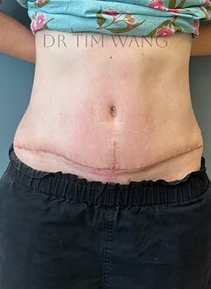 Before and After — Dr Tim Wang