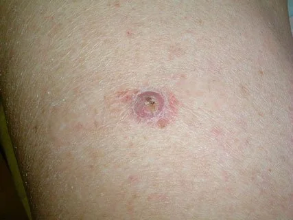 Sutherland Skin Cancer and Laser Clinic