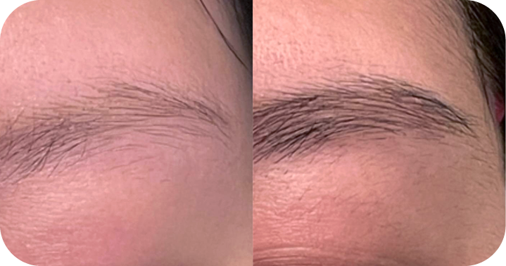 Brow Regrowth After Over-Plucking Using Controlled Collagen Induction ...