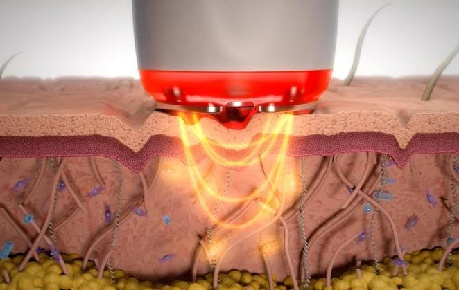 Face Sculpting Ionic RF — La Dermalogique