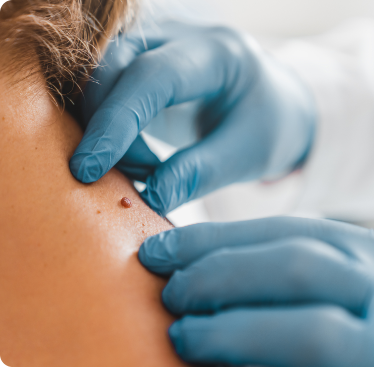 The Mole Clinic | Skin Cancer Clinics