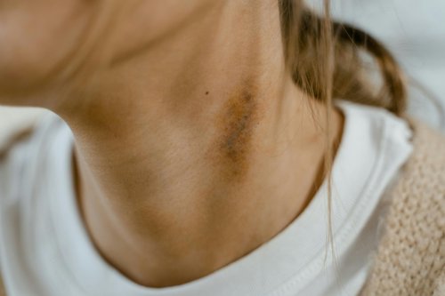 Stages of Wound Healing with Pictures | Wound Recovery Guide ...