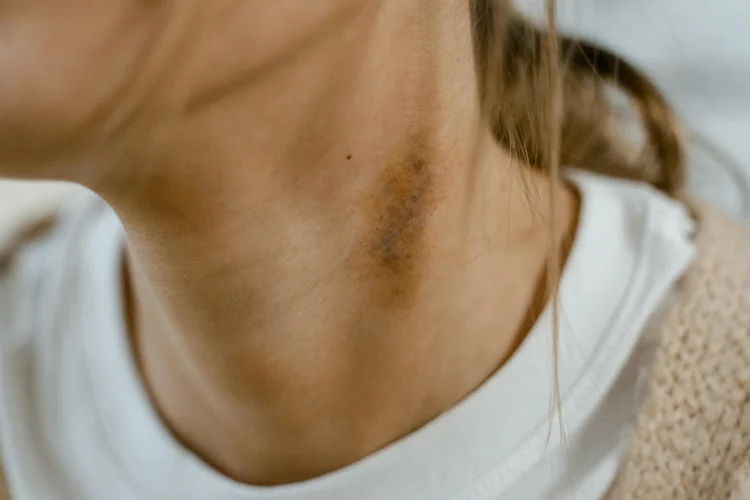 Stages of Wound Healing with Pictures | Wound Recovery Guide ...