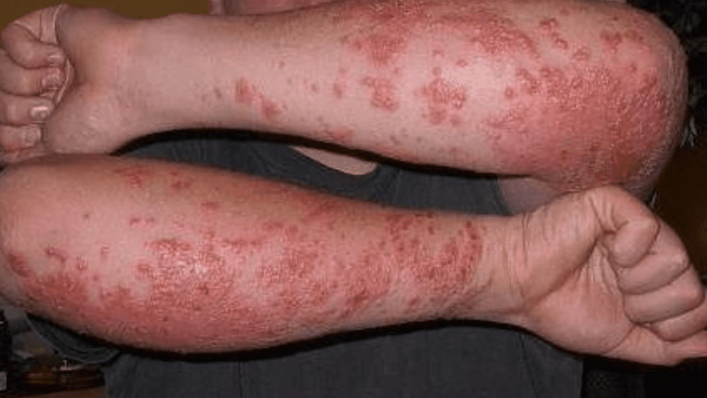 Essential Oils for Poison Ivy — Essential Oils Articles