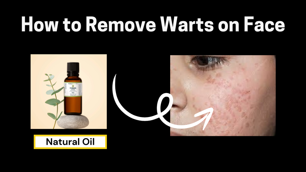 Natural Treatment for Facial Warts: Home Remedies — Essential Oils Articles