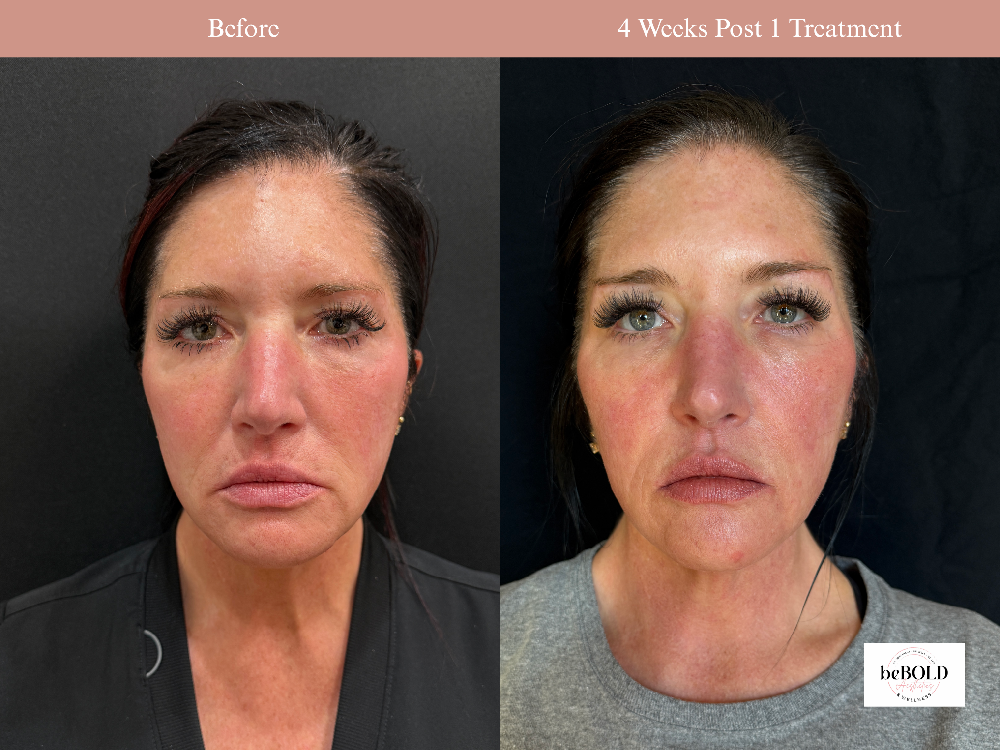 AuraLux Skin Rejuvenation in Lakewood | beBOLD Aesthetics & Wellness