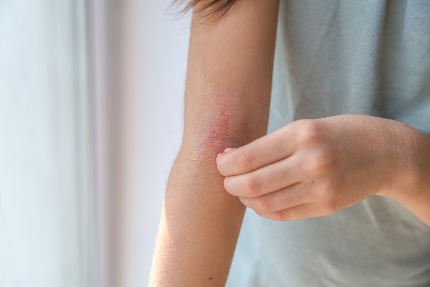 Itchy Skin — Esapharm