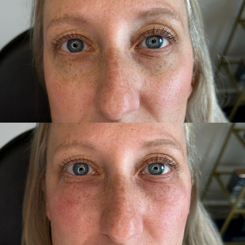 PRF Under Eye Treatment Rochester, NY — Sorella Aesthetics