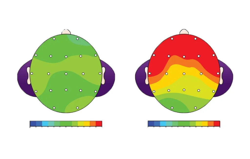 What to Expect from a qEEG Brain Map | Brain Health Guide — Brain Train ...