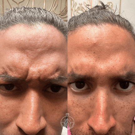 Botox | Enhance Your Look - Book Now — The Aesthetic Lab: Best Med Spa ...